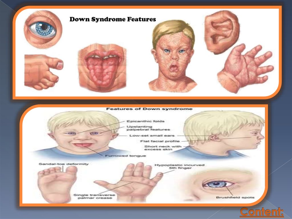 Down Syndrome Anatomy
