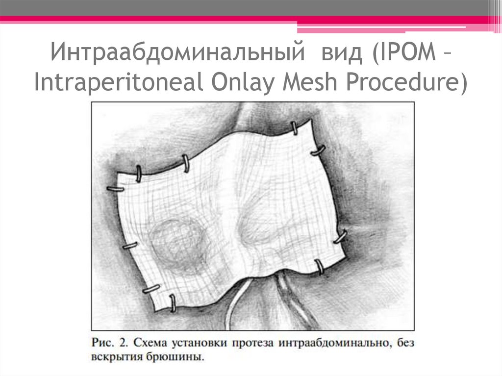 Эндовидеохирургические технологии в лечении грыж - online presentation