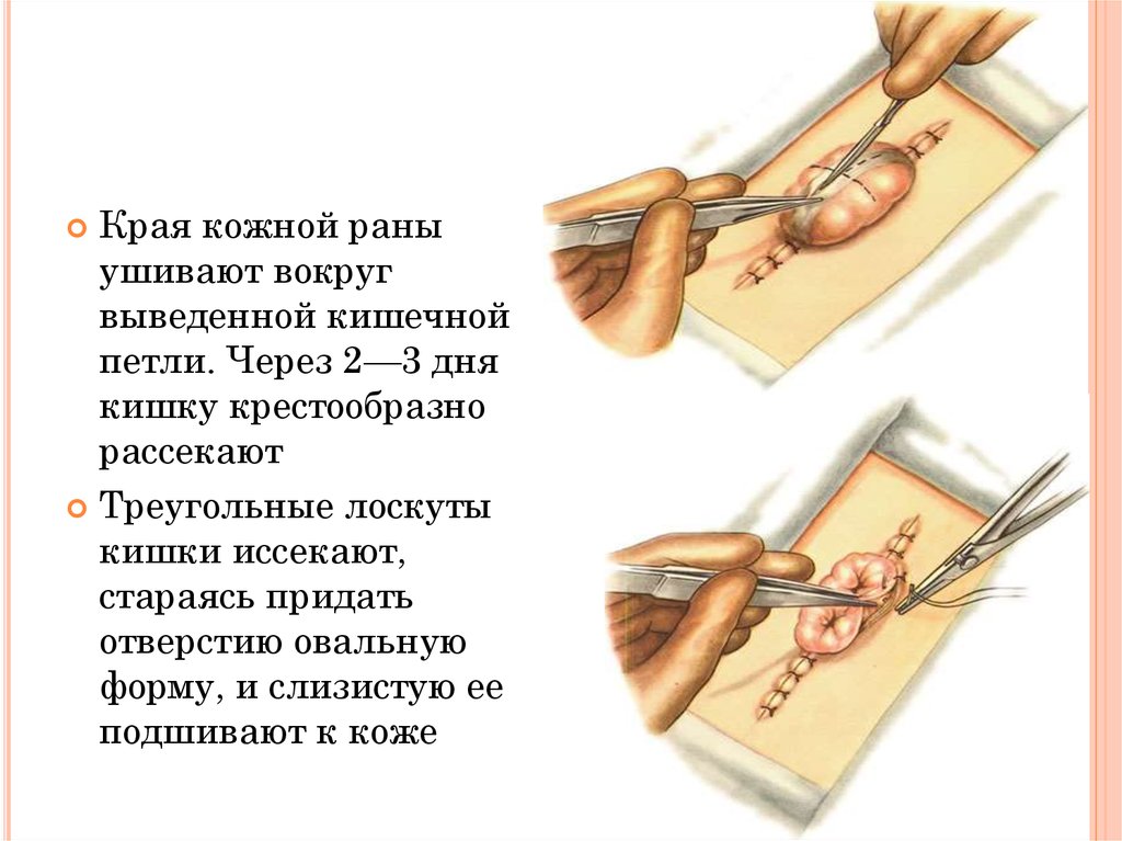 Противоестественный задний проход и колостома - презентация онлайн