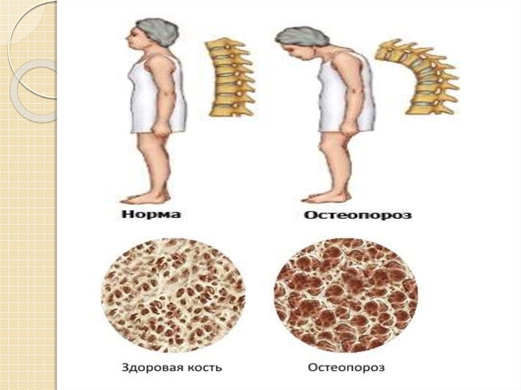 Остепороз - презентация онлайн