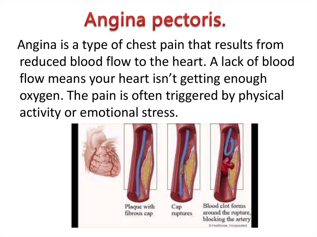 Angina Pectoris Sequence Of Tenses Online Presentation